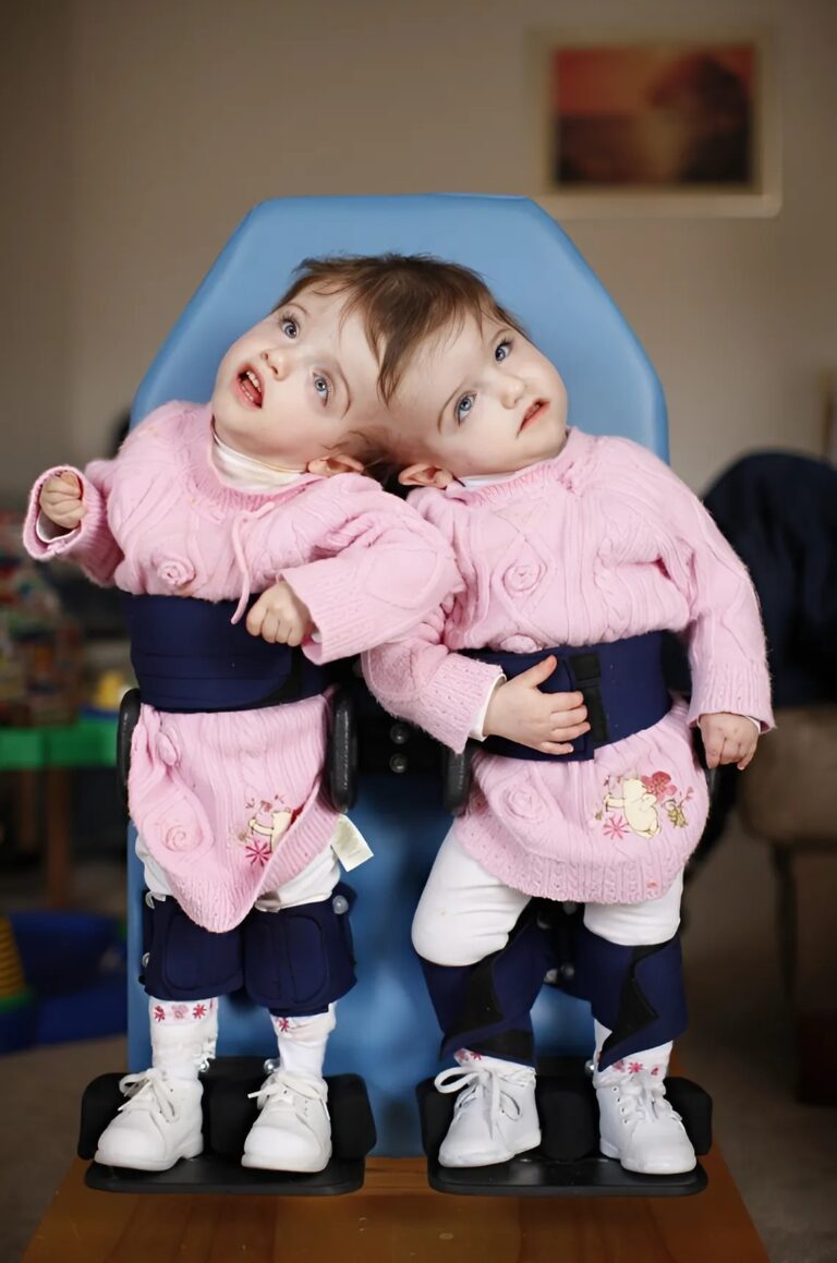 The sisters were born conjoined at the head and survived despite ...