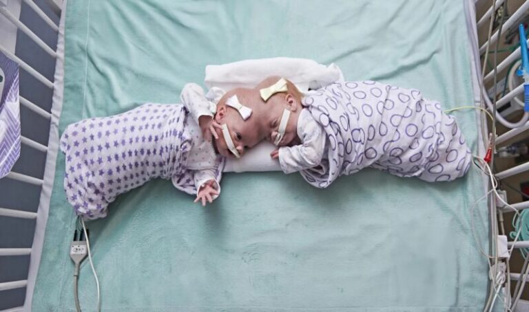 Siamese twins were separated a year after birth: this is how they look ...