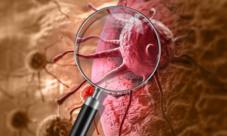 Does Cancer Have a Smell? A Scientific Fact, Not a Myth - Interesting News